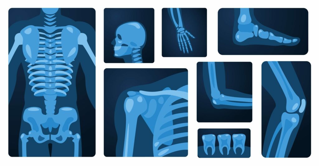 Bone Health and Diabetes: What You Need To Know